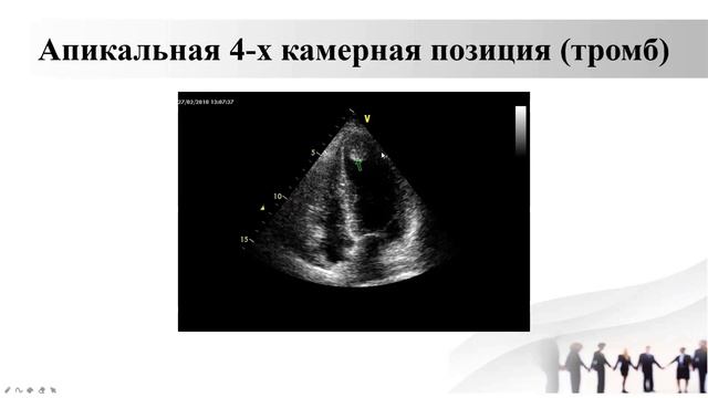 6 ЭХОКГ.mp4