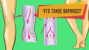 Что такое варикоз?