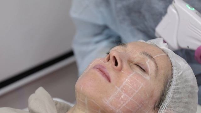 Обучение СМАС-лифтингу в клинике МАК