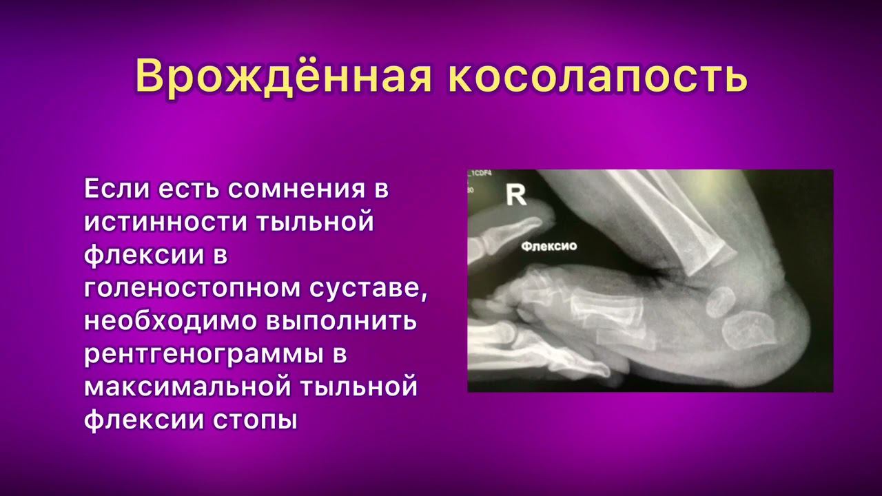 Врожденная косолапость