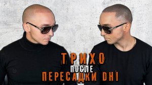 Трихопигментация после пересадки волос DHI. Загущение прически. Scalp Micropigmentation SMP tattoo