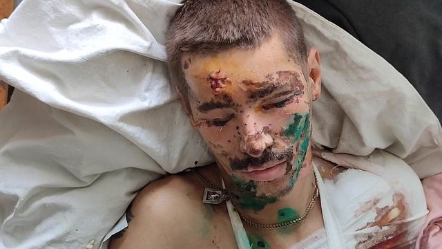 Тяжелораненный военнопленный Украины, Всу