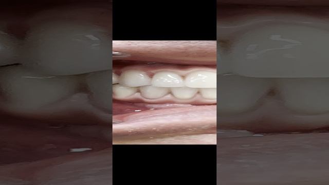 Постоянный керамокомпозитный протез устанавливается сразу и включен в стоимость операции All-On-4