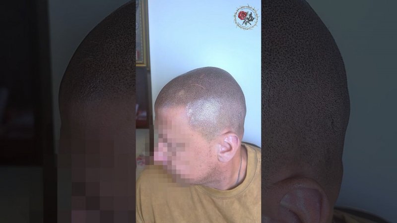 Нет облысению! Трихопигментация воссоздание прически тату волос лучше чем пересадка SMP scalp tattoo