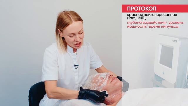 RF-лифтинг VIVACE. Кейс: Владимир, 59 лет, мышечный тип старения