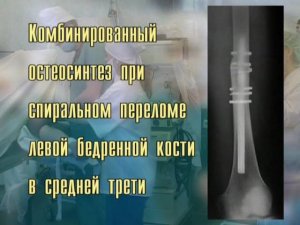 Комбинированный остеосинтез при спиральном переломе левой бедренной кости в средней трети
