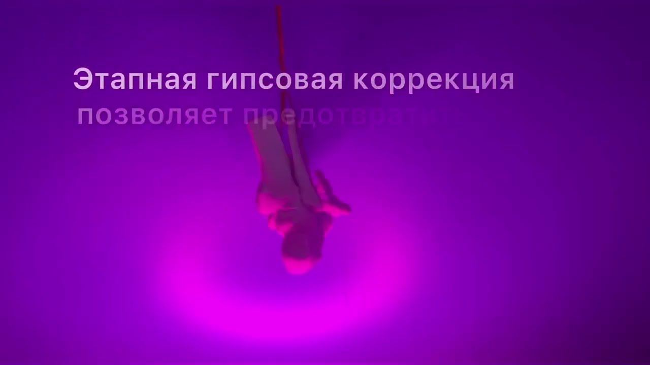 Этапная гипсовая коррекция деформации стоп