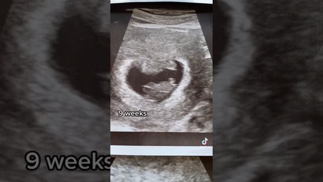 TRIGGER WARNING! Miscarriage | Ultrasound Photos from Embryo to 13 Weeks | Heartbreaking IVF Update