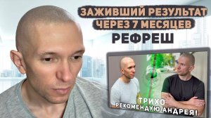 Заживший результат перед обновлением цвета. Трихопигментация лучше чем пересадка волос SMP