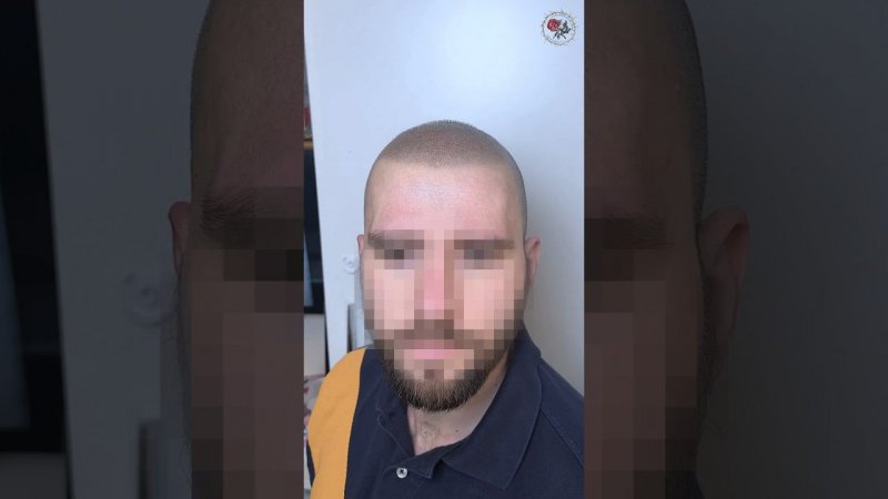 Вернул себе прическу! Бритый парень вместо лысого. Трихопигментация Smp Scalp micropigmentation