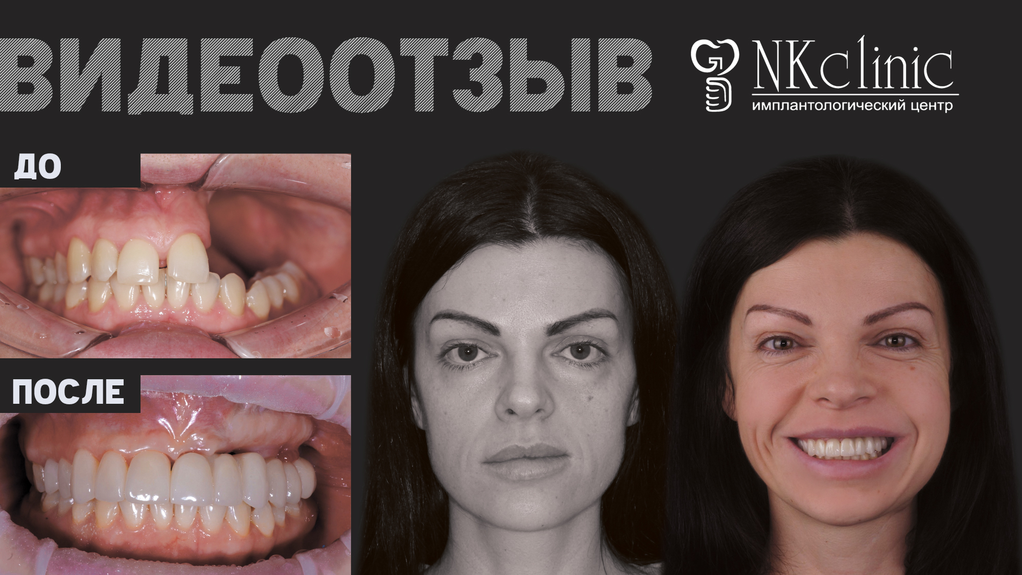 Протезирование и восстановление верхней челюсти