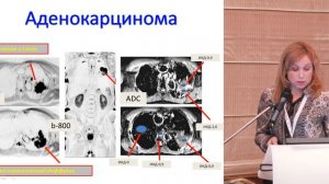 МРТ ДВИ (DWI) в диагностике очаговых поражений органов грудной клетки