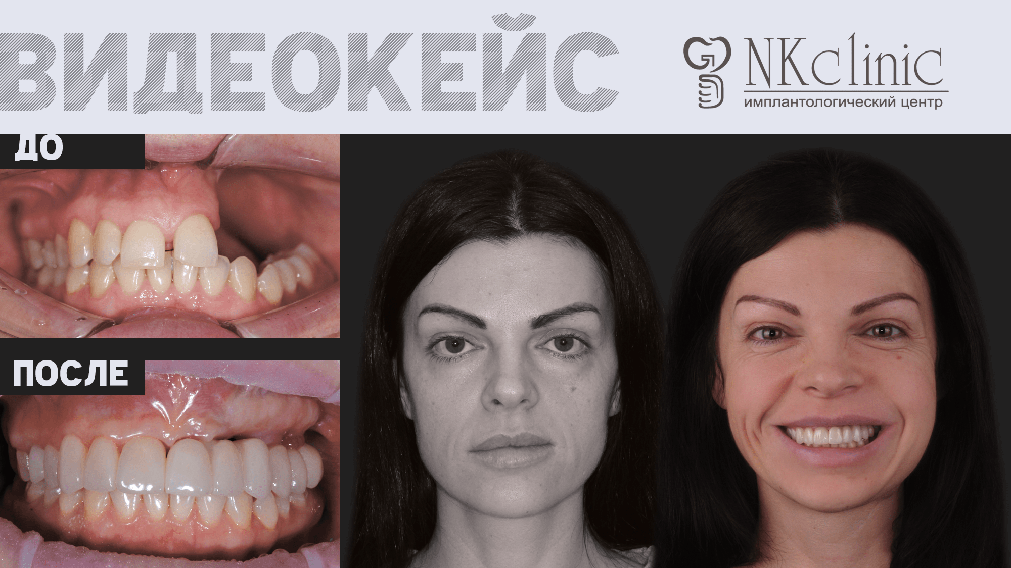 Протезирование и восстановление верхней челюсти