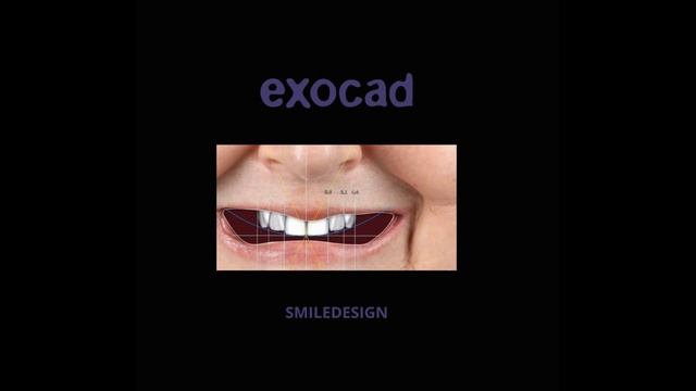 Maycon Gaspar - Exocad smile design