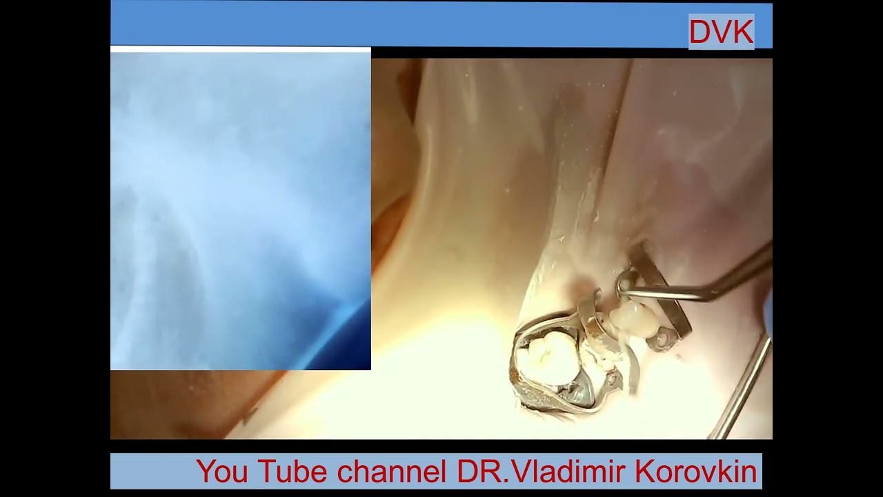 Einbau eines Glasfaserstifts in den Kanal des 45. Zahns. Firmen „Forma“, Russland.#dentistry