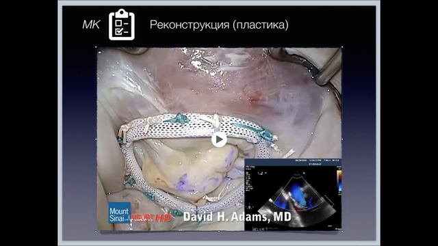 ППС-3-МН