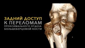 Задний доступ к переломам проксимального отдела большеберцовой кости.