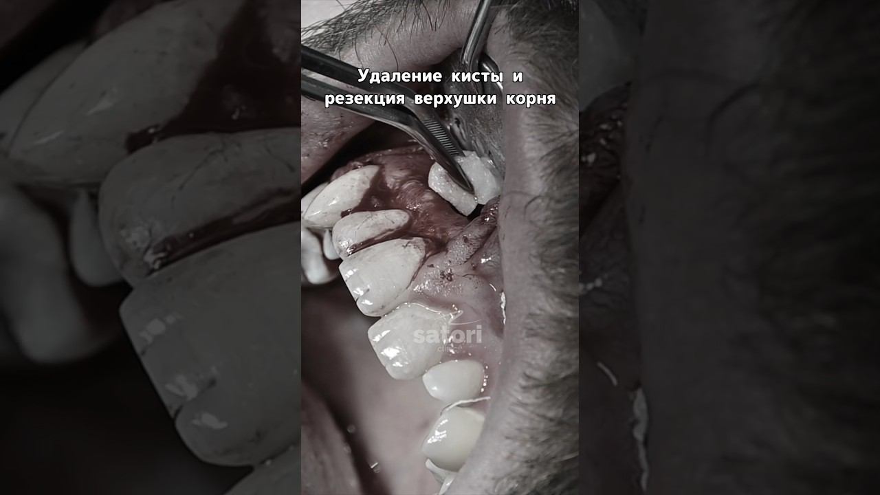 Киста верхушки зуба #зубы #стоматология
