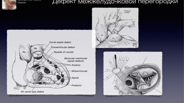 ВПС-3