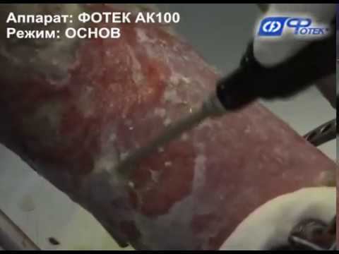 Ультразвуковая обработка гнойной раны