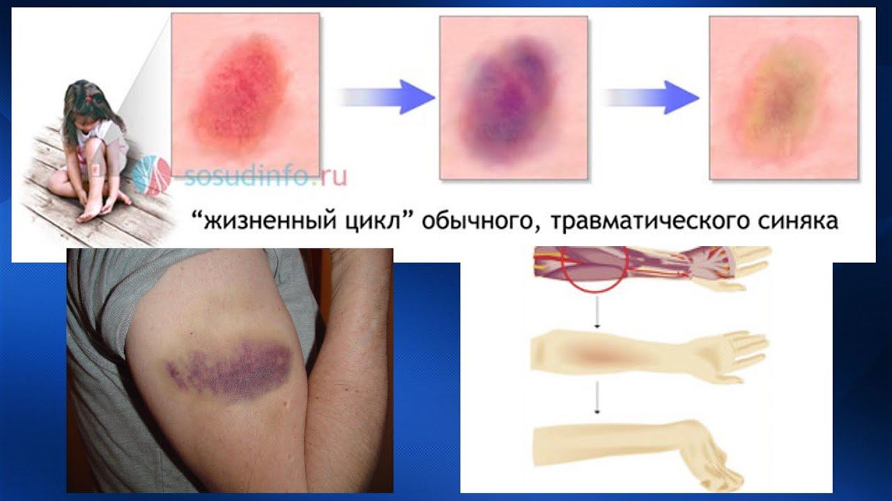 2.06. Массаж при ушибах, растяжениях | Медицинский массаж. Цикл 2
