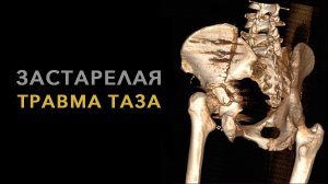 Поездная застарелая травма таза